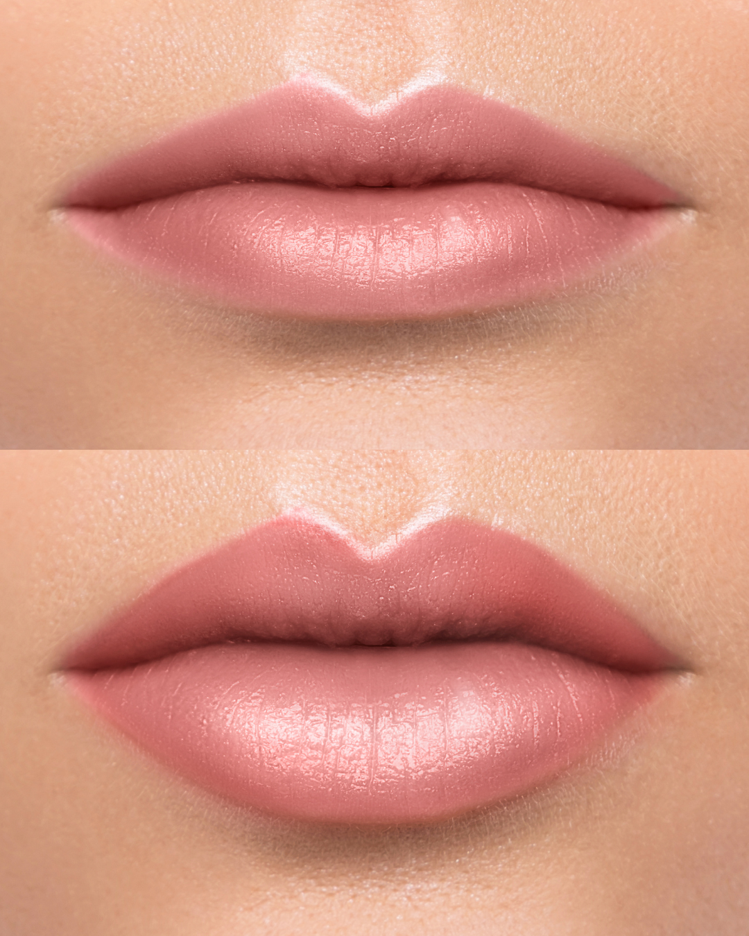 Lip Filler, avoiding duck lips | Elite Medical & Aesthetics | Lone Tree ...