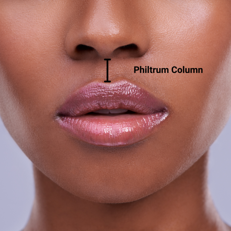 Lip Filler, avoiding duck lips | Elite Medical & Aesthetics | Lone Tree ...