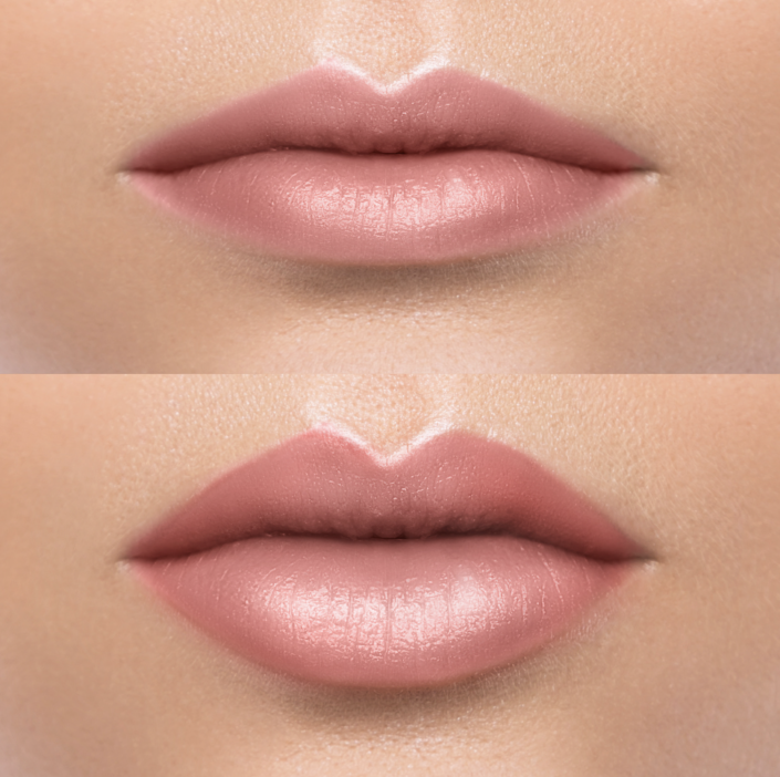 Lip Filler, avoiding duck lips | Elite Medical & Aesthetics | Lone Tree ...