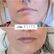 Lip Filler, avoiding duck lips | Elite Medical & Aesthetics | Lone Tree ...