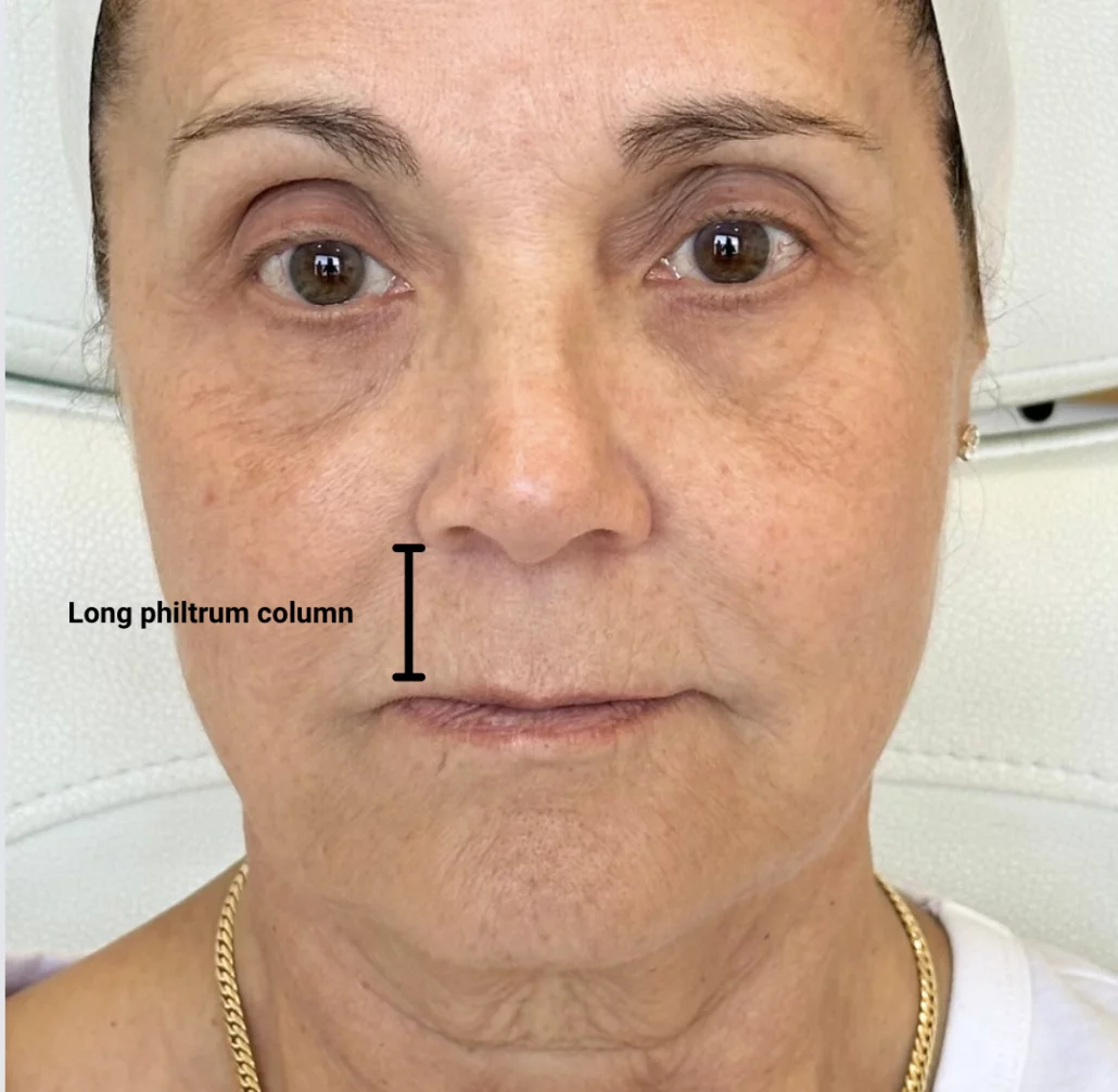 Lip Filler, avoiding duck lips | Elite Medical & Aesthetics | Lone Tree ...