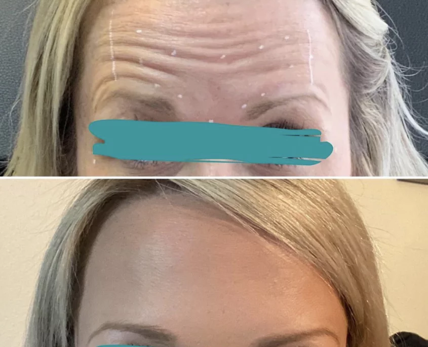 How Much Does Botox Really Cost? | Elite Medical & Aesthetics | Lone ...