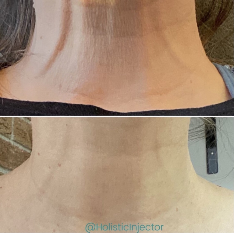 Everything You Need to Know About Laser Skin Tightening | Elite Medical ...