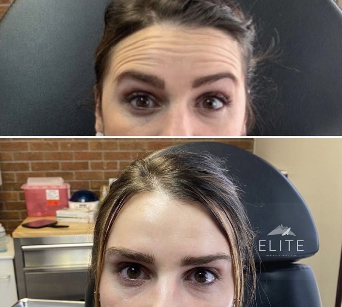 Botox VS. Dysport- Which Is Right For You? | Elite Medical & Aesthetics ...