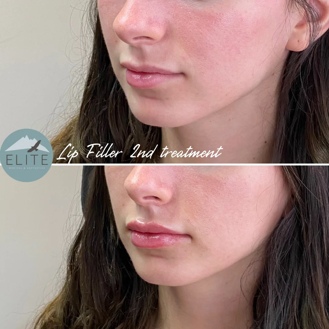 How to Make the Most Out of Your Aesthetic Treatments | Elite Medical ...
