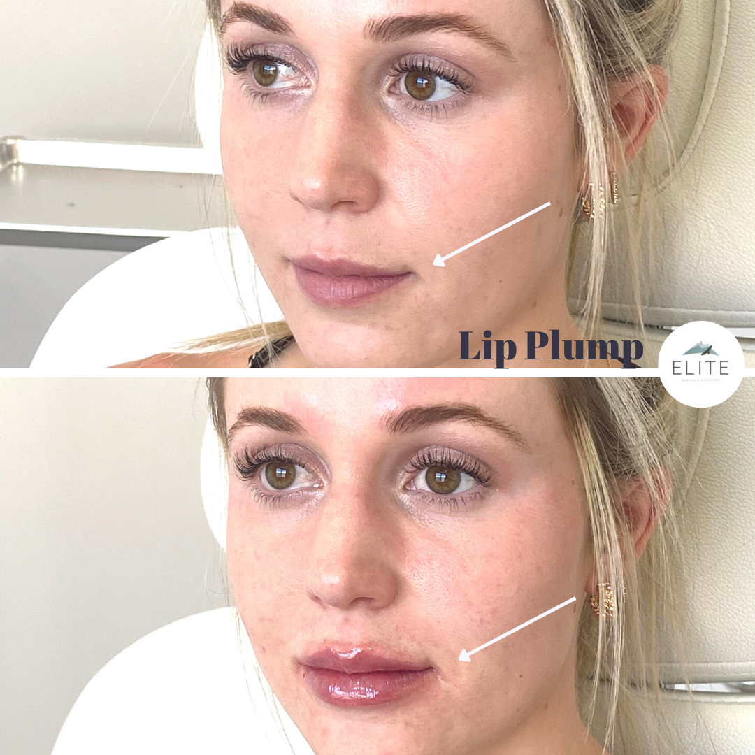 Our Favorite "Glow up" Treatments | Elite Medical & Aesthetics | Lone ...