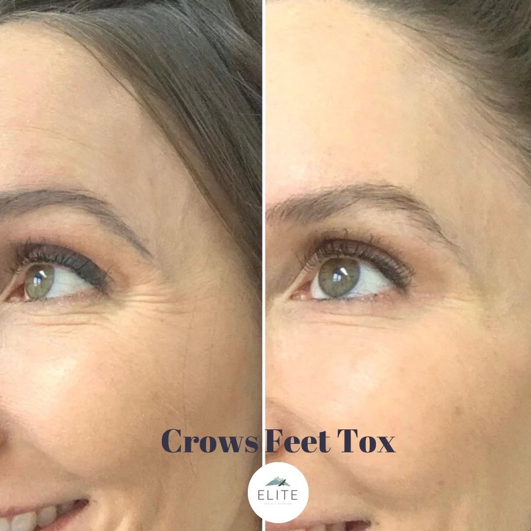 Botox | Elite Medical & Aesthetics | Lone Tree, CO 80124