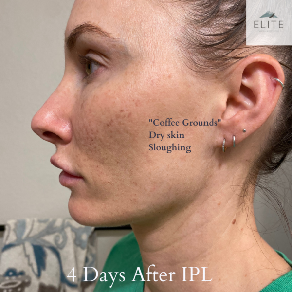 What to expect after an IPL | Elite Medical & Aesthetics | Lone Tree ...