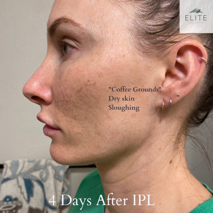 What to expect after an IPL | Elite Medical & Aesthetics | Lone Tree ...