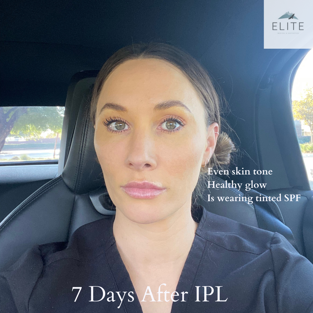 What to expect after an IPL | Elite Medical & Aesthetics | Lone Tree ...
