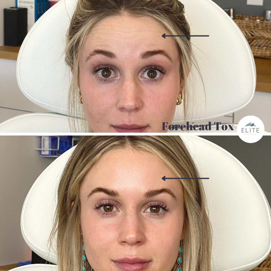Botox | Elite Medical & Aesthetics | Lone Tree, CO 80124