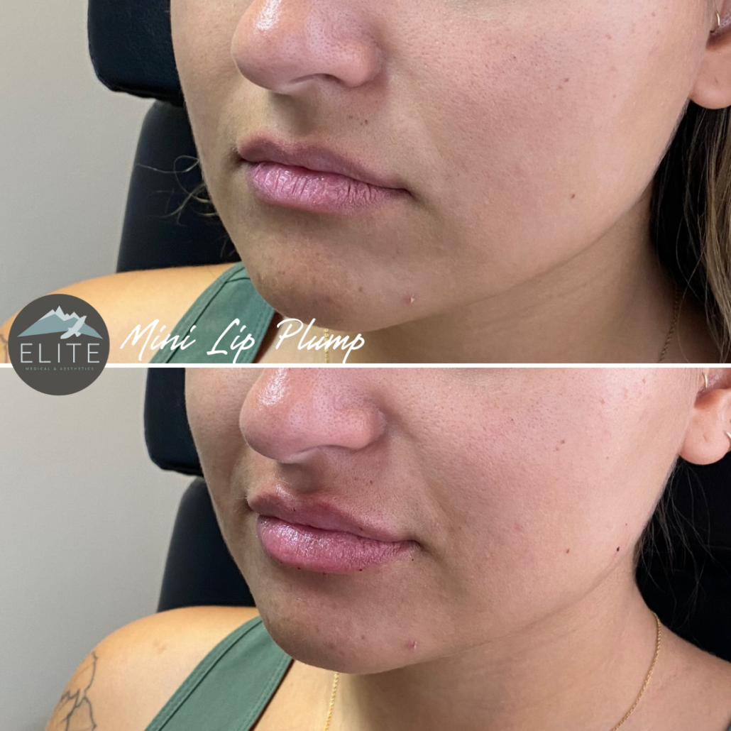 Versa | Elite Medical & Aesthetics | Lone Tree, CO 80124