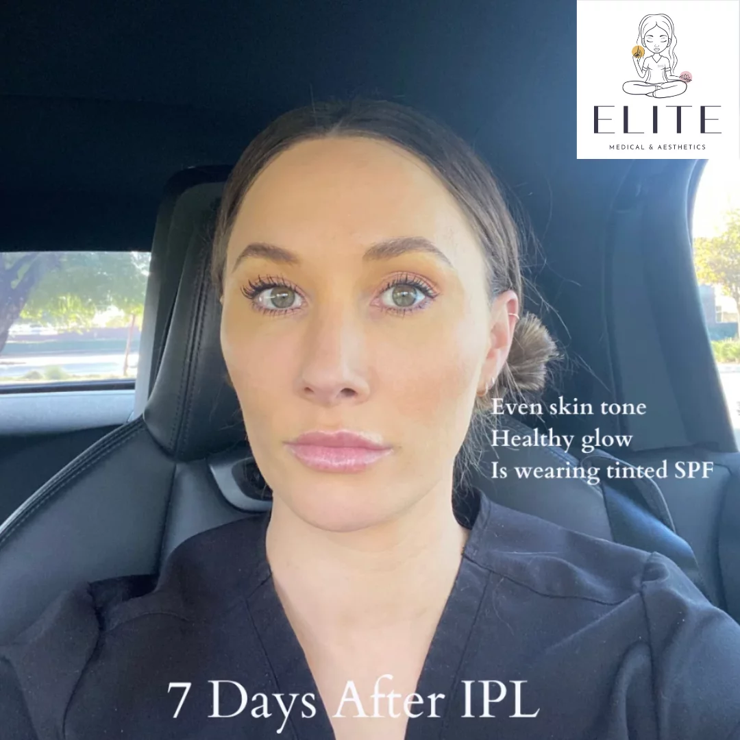 What to expect after an IPL | Elite Medical & Aesthetics | Lone Tree ...