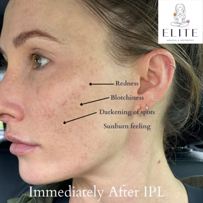 What to expect after an IPL | Elite Medical & Aesthetics | Lone Tree ...