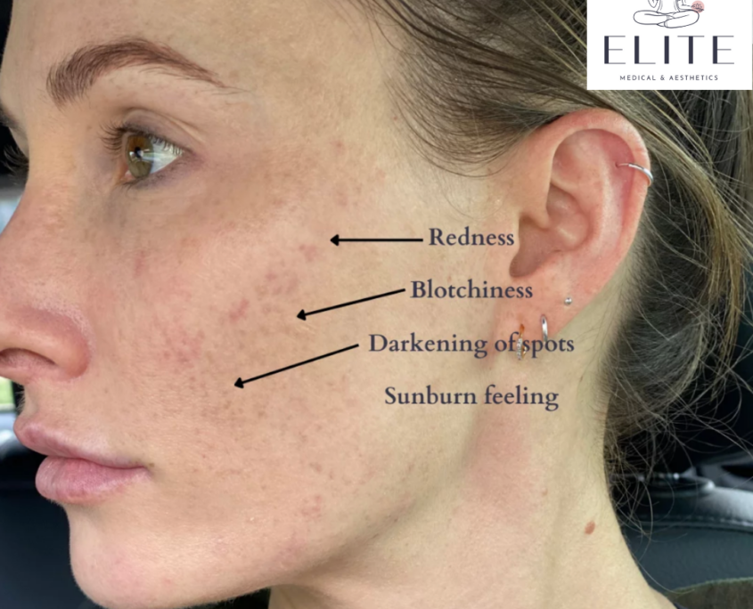 All About Under Eyes | Elite Medical & Aesthetics | Lone Tree, CO 80124