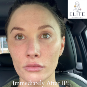 What to expect after an IPL | Elite Medical & Aesthetics | Lone Tree ...