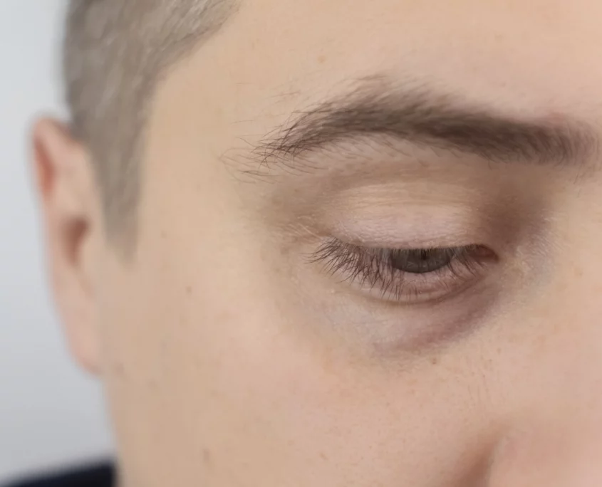 All About Under Eyes | Elite Medical & Aesthetics | Lone Tree, CO 80124