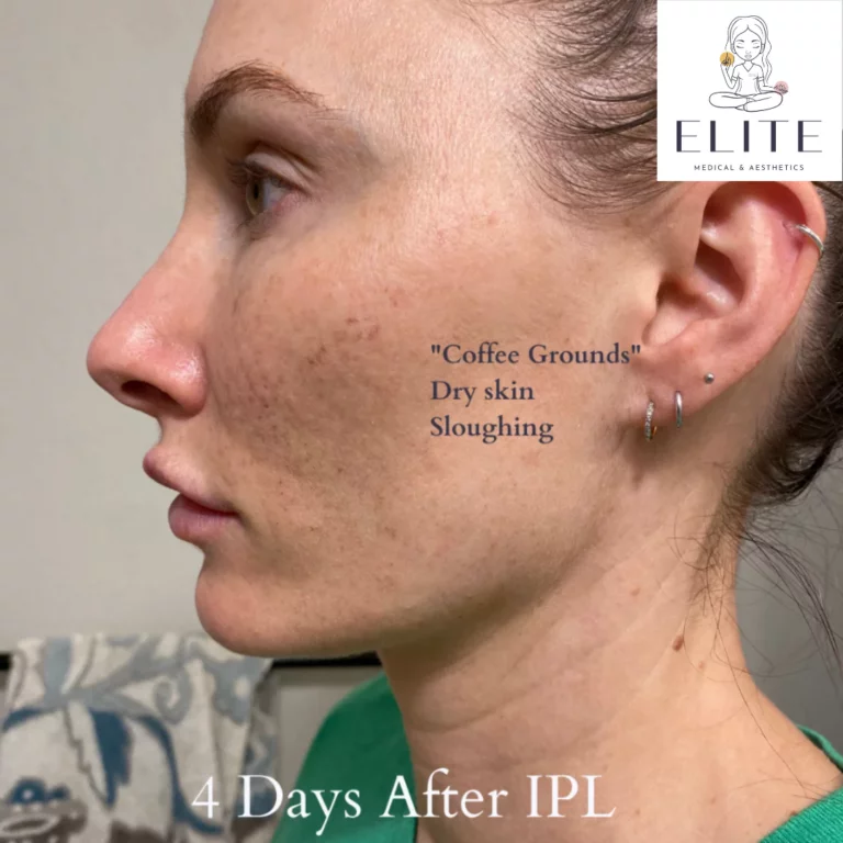What to expect after an IPL | Elite Medical & Aesthetics | Lone Tree ...
