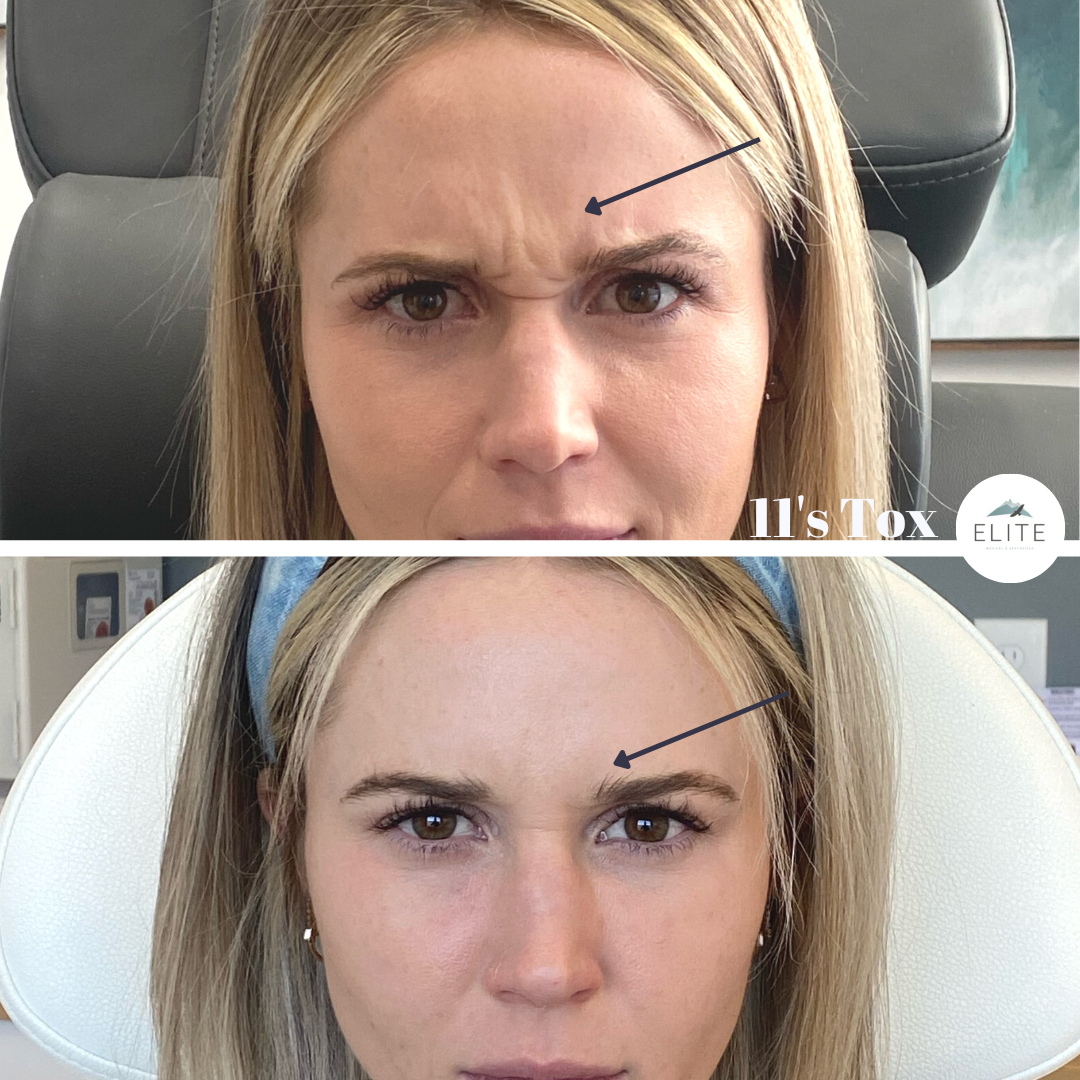Botox/Xeomin | Elite Medical & Aesthetics | Lone Tree, CO 80124