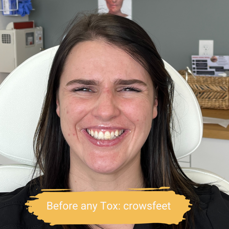 How Botox Kicks In | Elite Medical & Aesthetics | Lone Tree, CO 80124