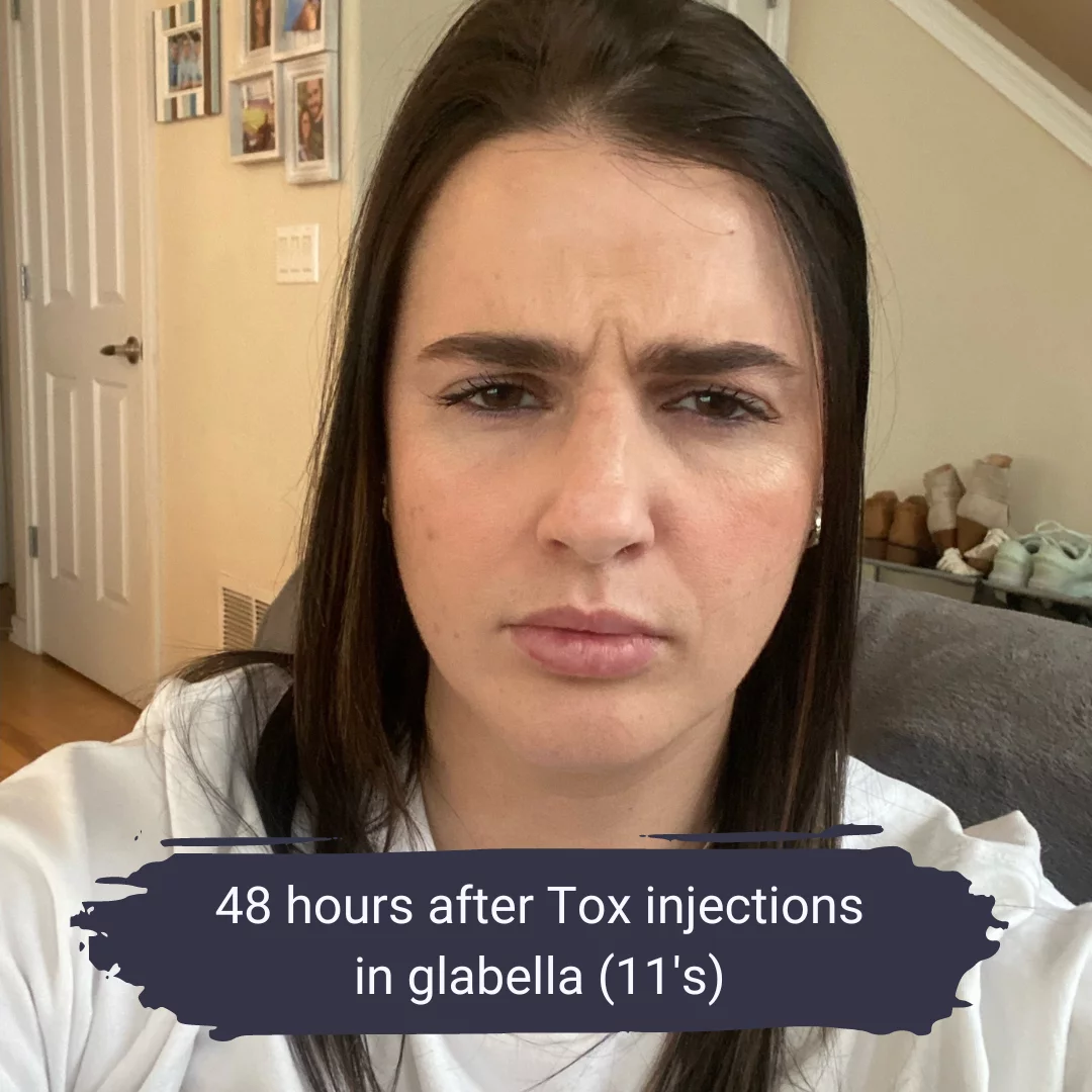 How Botox Kicks In | Elite Medical & Aesthetics | Lone Tree, CO 80124