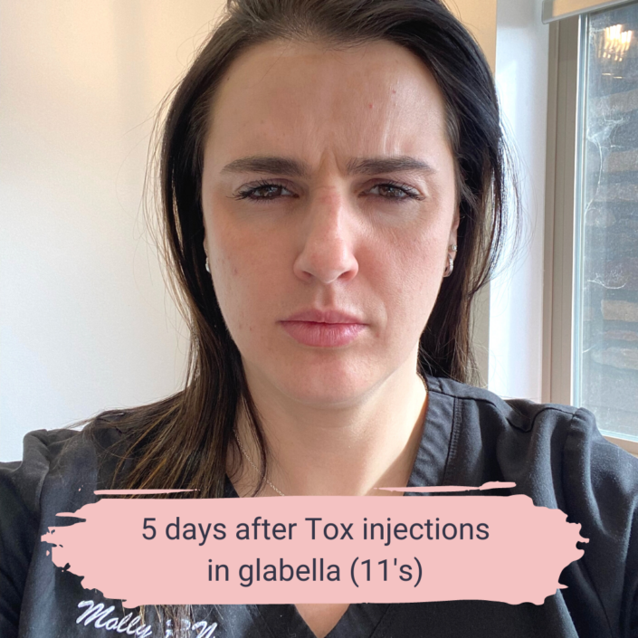 How Botox Kicks In | Elite Medical & Aesthetics | Lone Tree, CO 80124