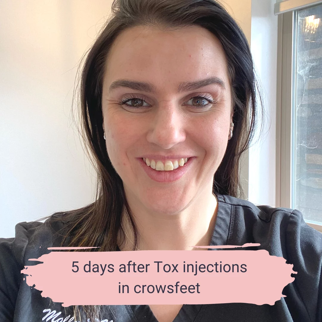 How Botox Kicks In | Elite Medical & Aesthetics | Lone Tree, CO 80124