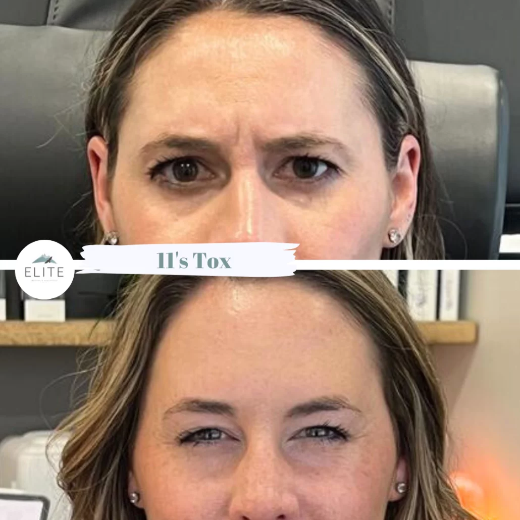 Botox VS. Dysport- Which Is Right For You? | Elite Medical & Aesthetics ...