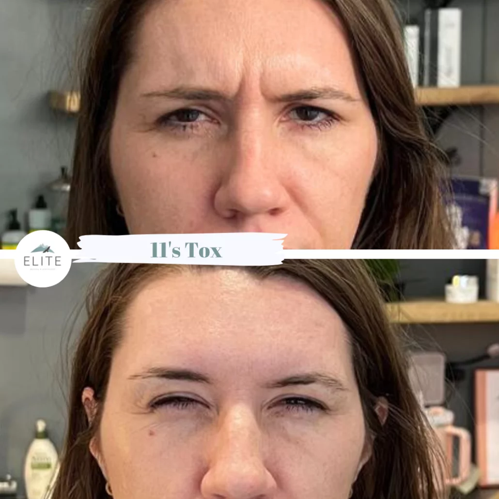 Can Botox Treat Depression? | Elite Medical & Aesthetics | Lone Tree ...