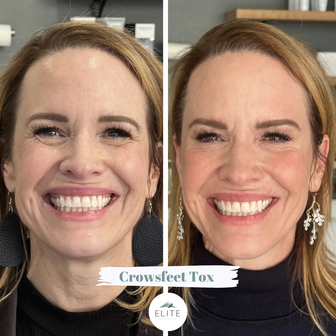 Botox 101 | Elite Medical & Aesthetics | Lone Tree, CO 80124