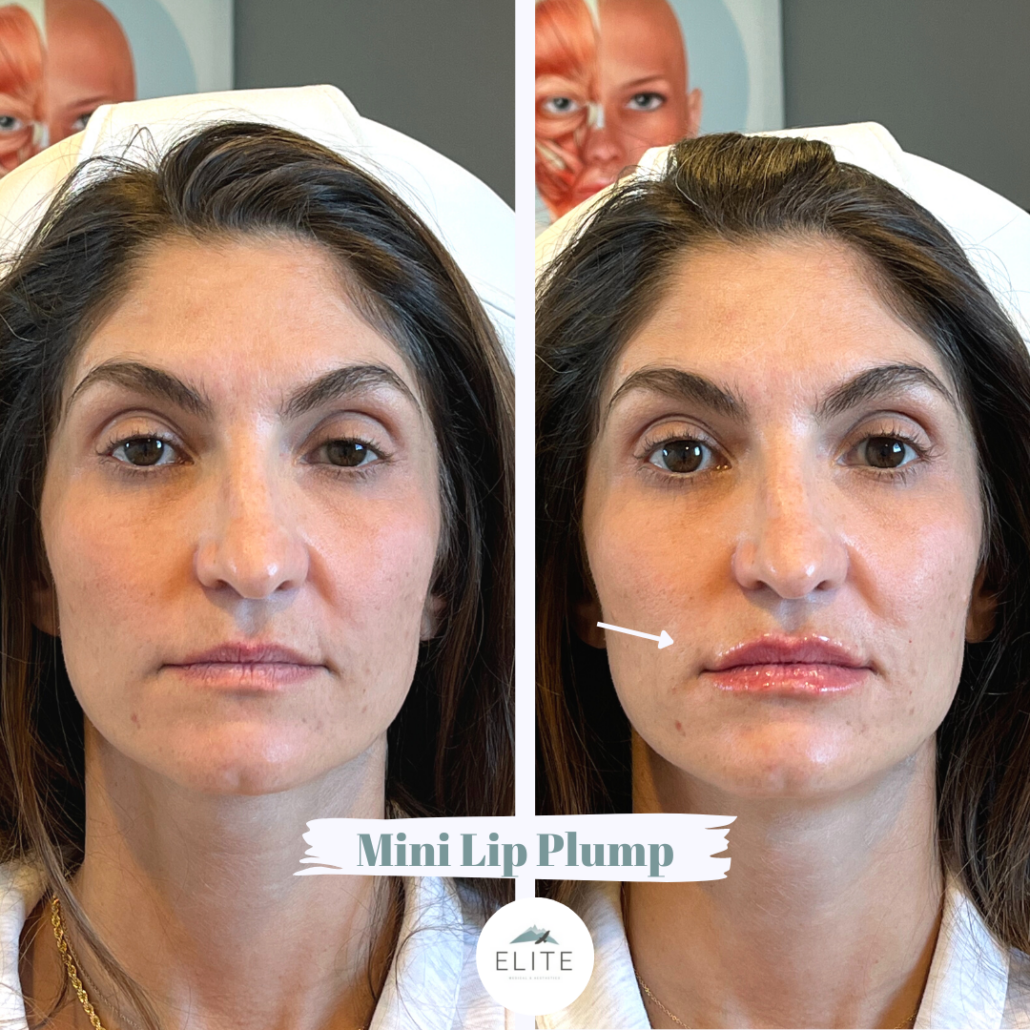 Lip Filler | Elite Medical & Aesthetics | Lone Tree, CO 80124