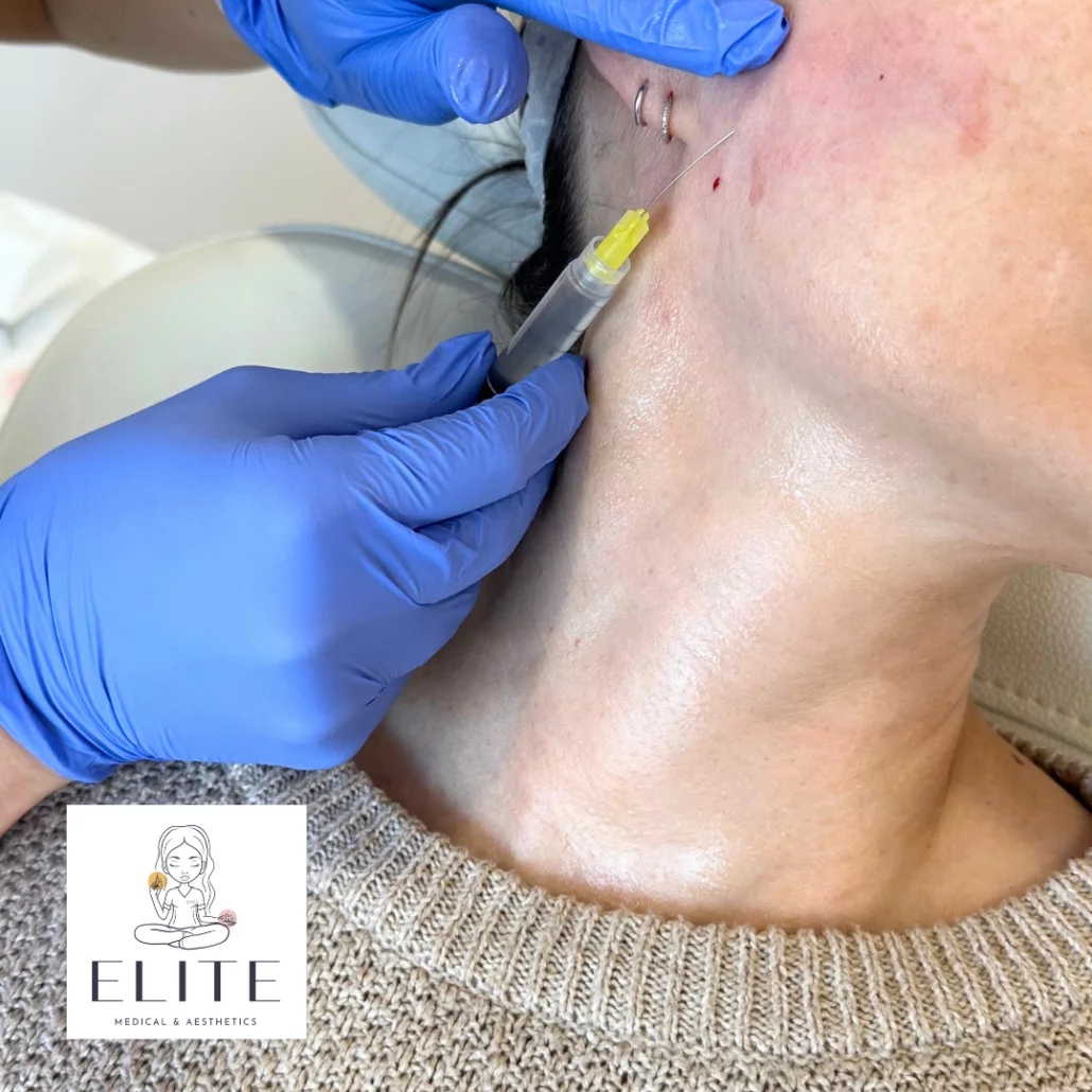 Sculptra | Elite Medical & Aesthetics | Lone Tree, CO 80124