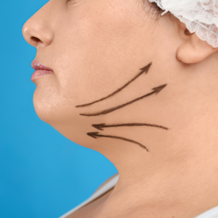 Double Chin/Jowls | Elite Medical & Aesthetics | Lone Tree, CO 80124