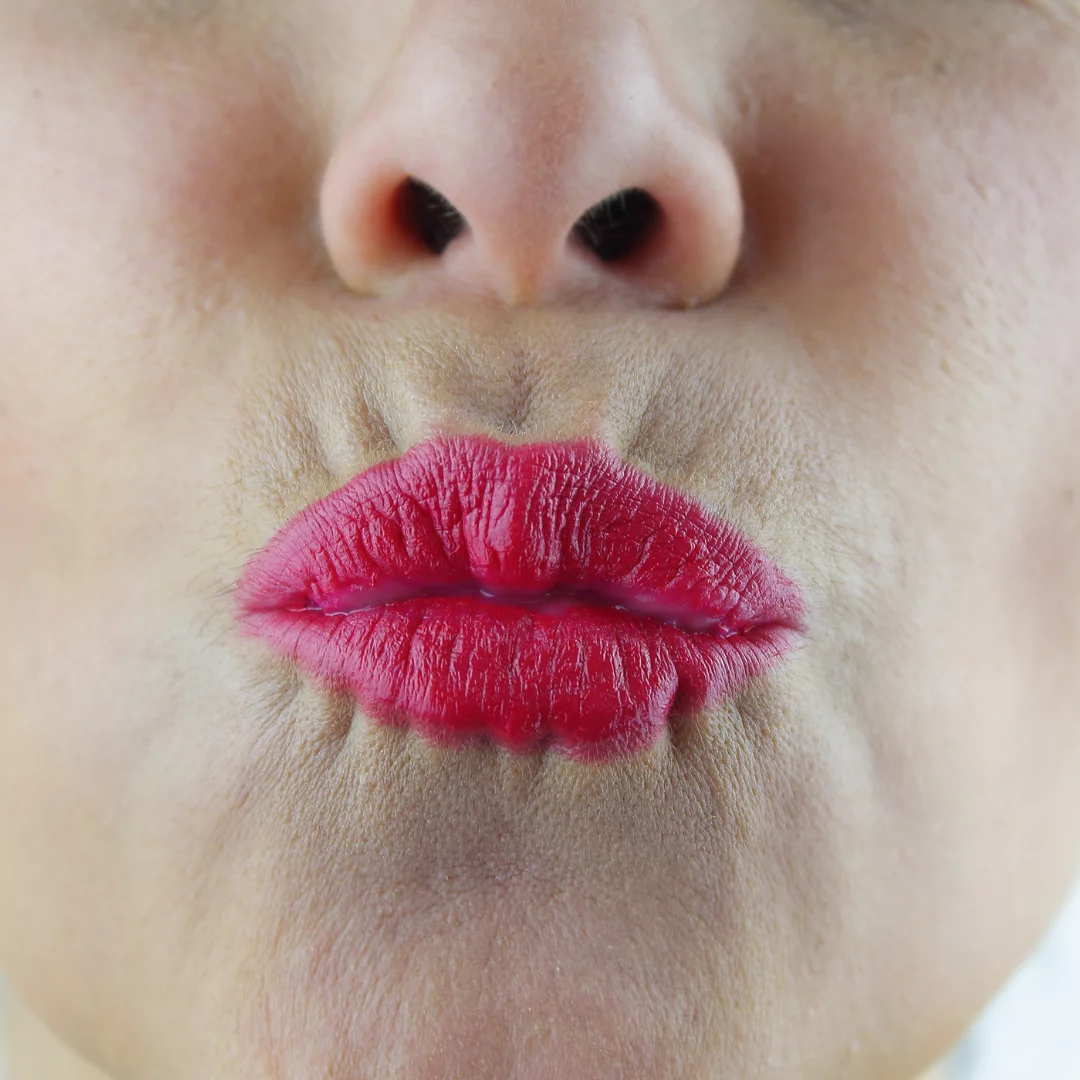 Lip Lines | Elite Medical & Aesthetics | Lone Tree, CO 80124