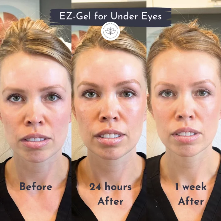 EZ Gel 101 | Elite Medical & Aesthetics | Lone Tree, CO 80124