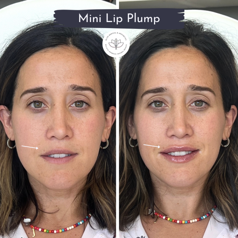 Tips to Reduce Lip Filler Swelling and Bruising | Elite Medical ...