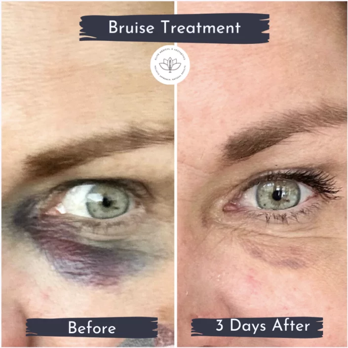 An Inside into IPL for Bruises | Elite Medical & Aesthetics | Lone Tree ...